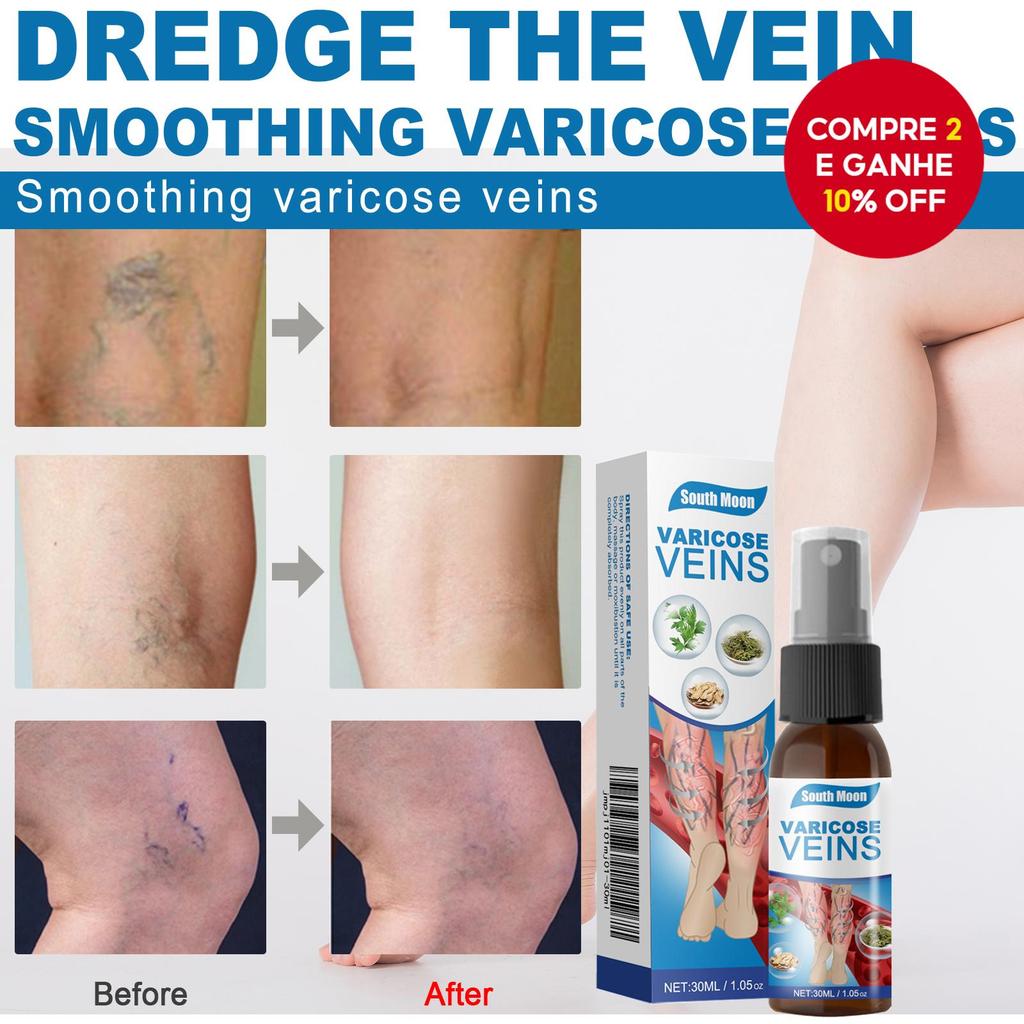 30ml Veinhealing Spray para Varizes, Tratamento para Aranhas Vasculares ...