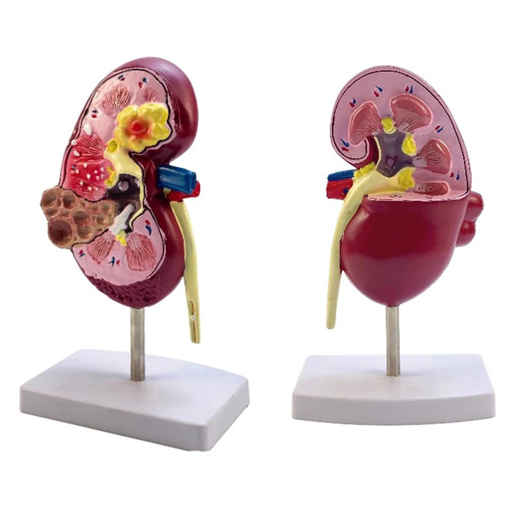 ⭐ Modelo Anatômico De Rim Normal E Patologia , Sistema Urinário Doente ...