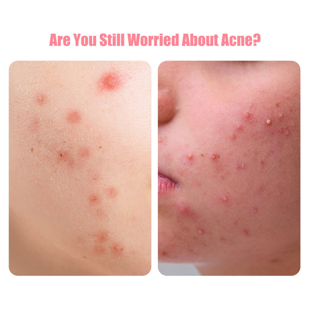 Estrela Espinha Acne Remendo Corretivo Facial Remendos Colorido ...